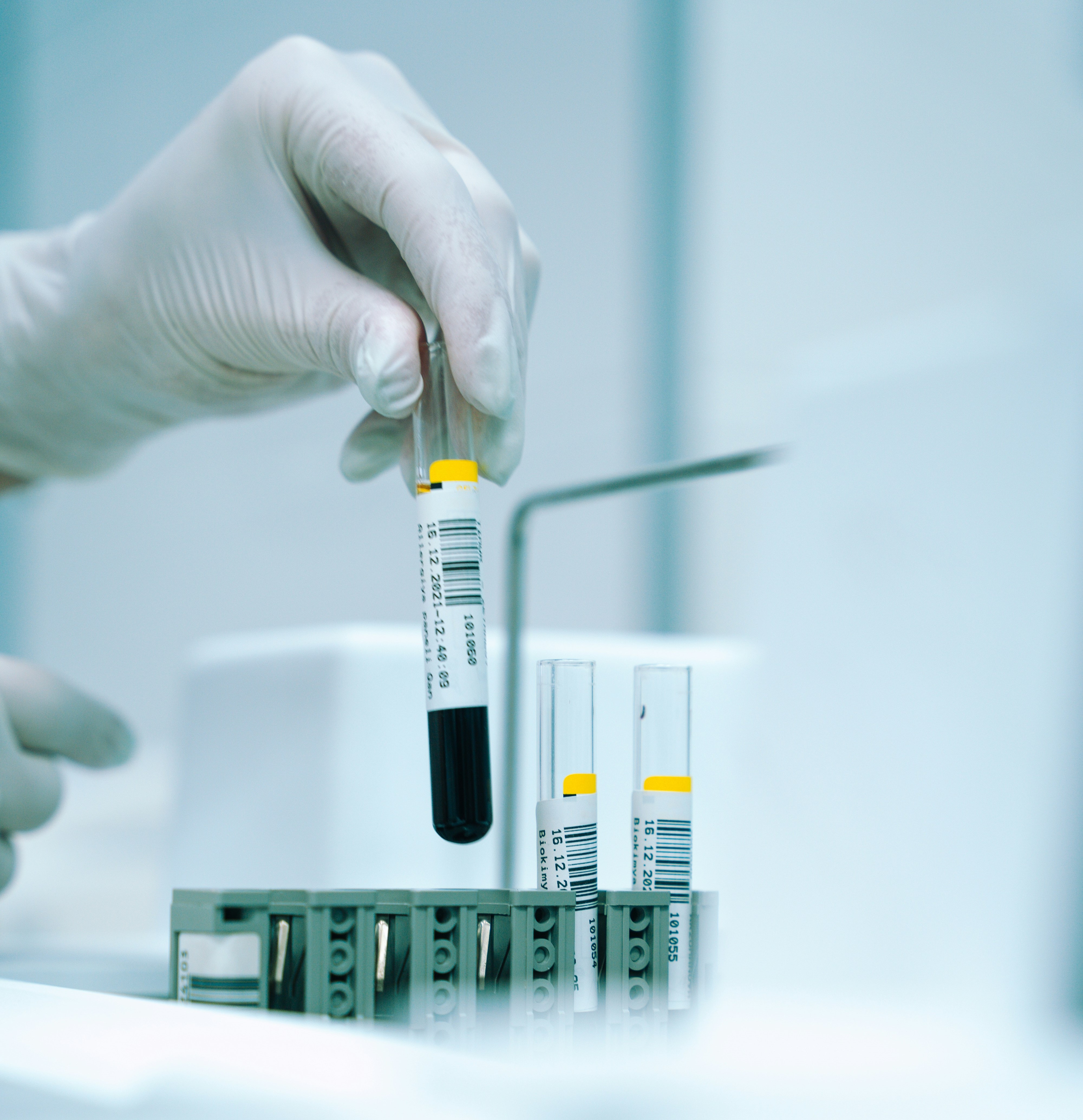 Blood biomarker test shows strong diagnostic accuracy for Alzheimer’s ...
